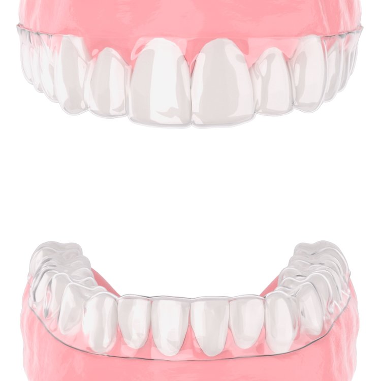 Upper & Lower Retainer only – Retainer Xpress